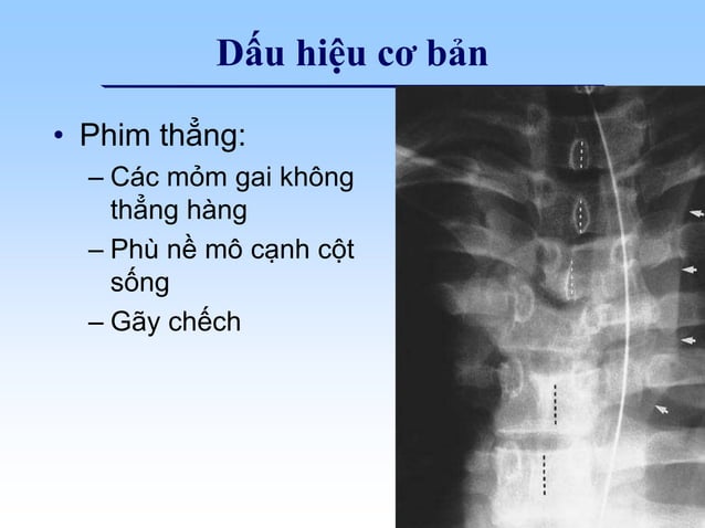 X QUANG CỘT SỐNG.pptx