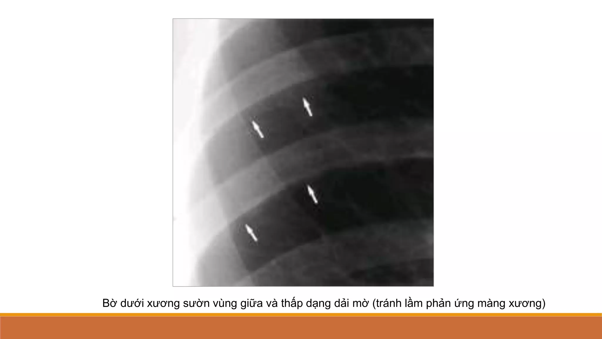 X quang ngực-module ho hap.pptx