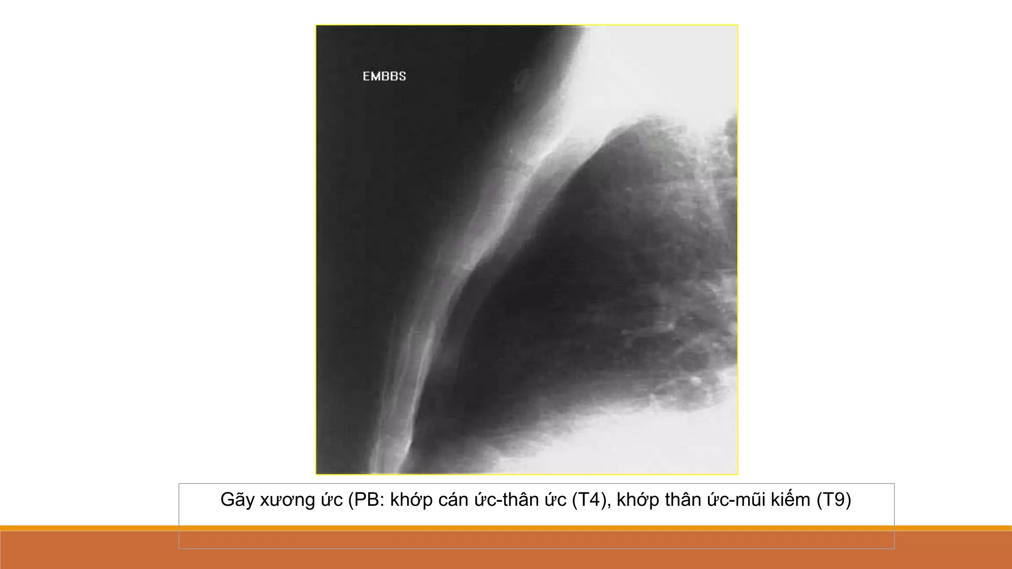 X quang ngực-module ho hap.pptx