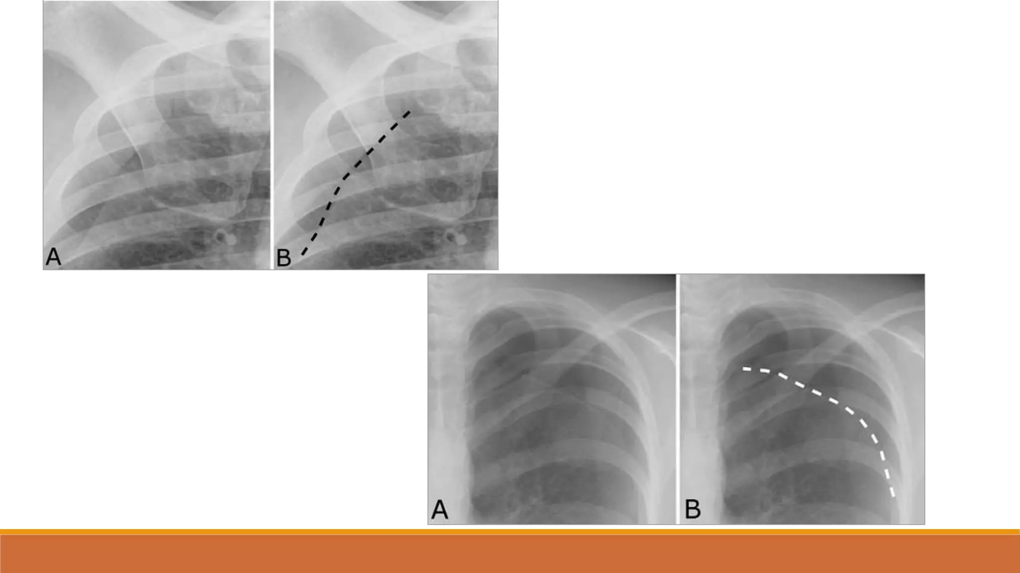 X quang ngực-module ho hap.pptx