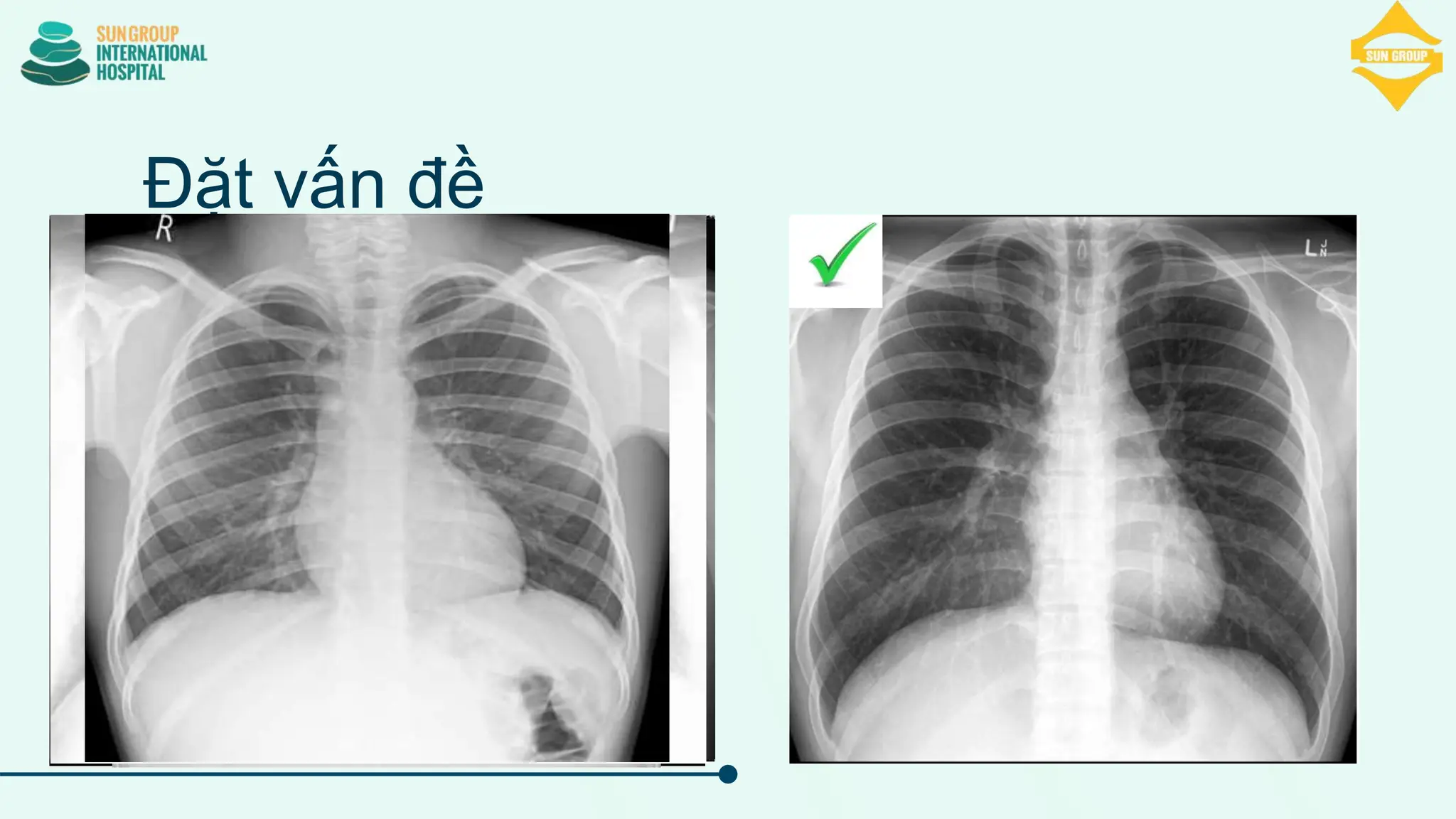 Tiêu chuẩn đánh giá phim chụp X Quang phổi thẳng đạt yêu cầu | PPTX