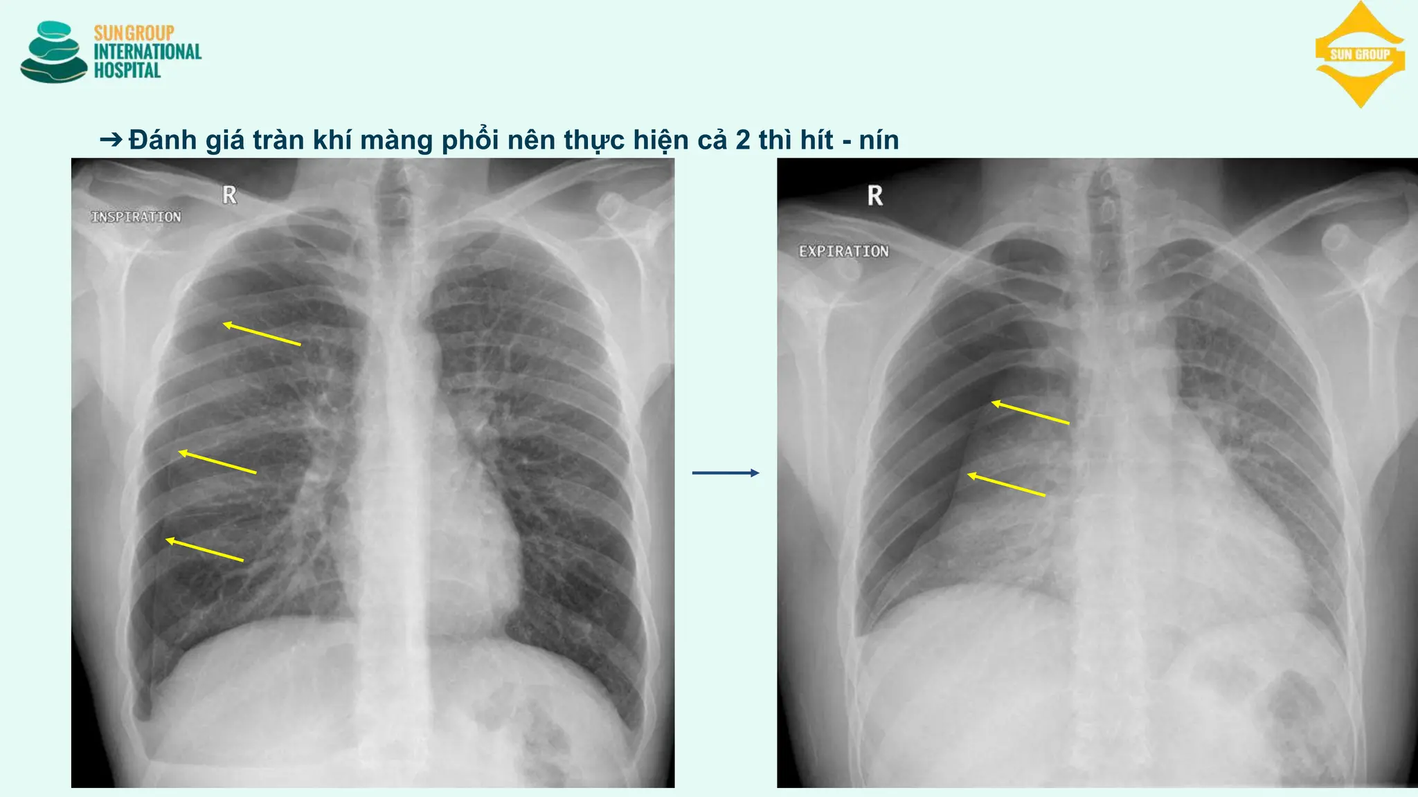 Tiêu chuẩn đánh giá phim chụp X Quang phổi thẳng đạt yêu cầu | PPTX