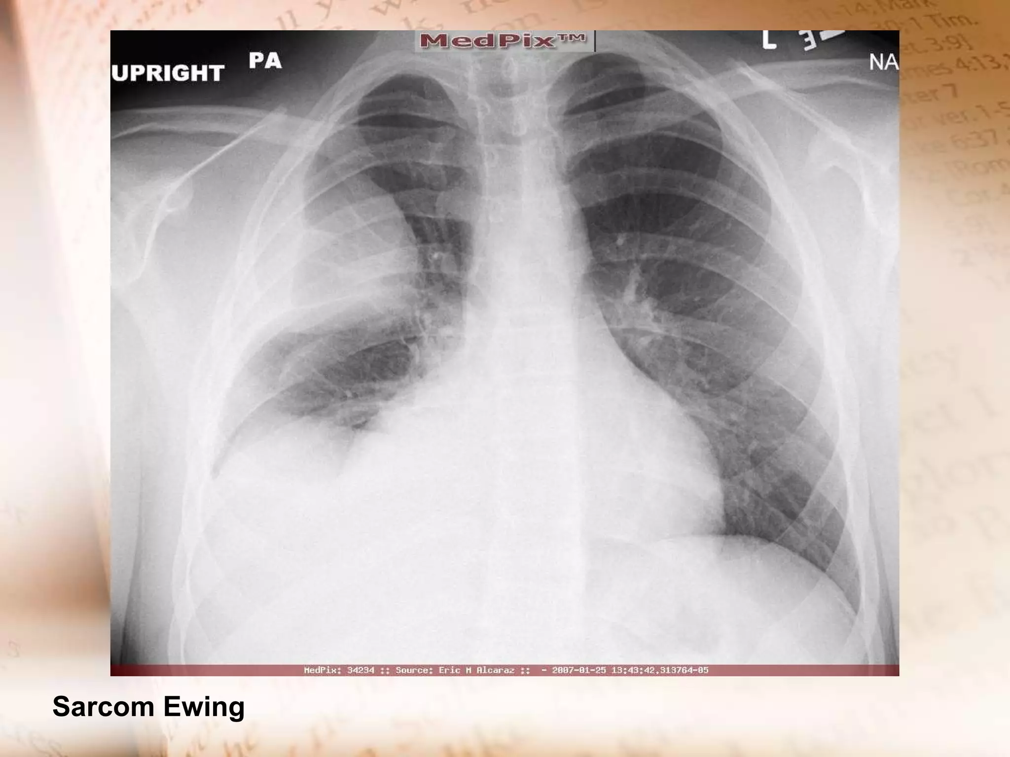 Xquang nguc hoi chung thanh nguc | PPT