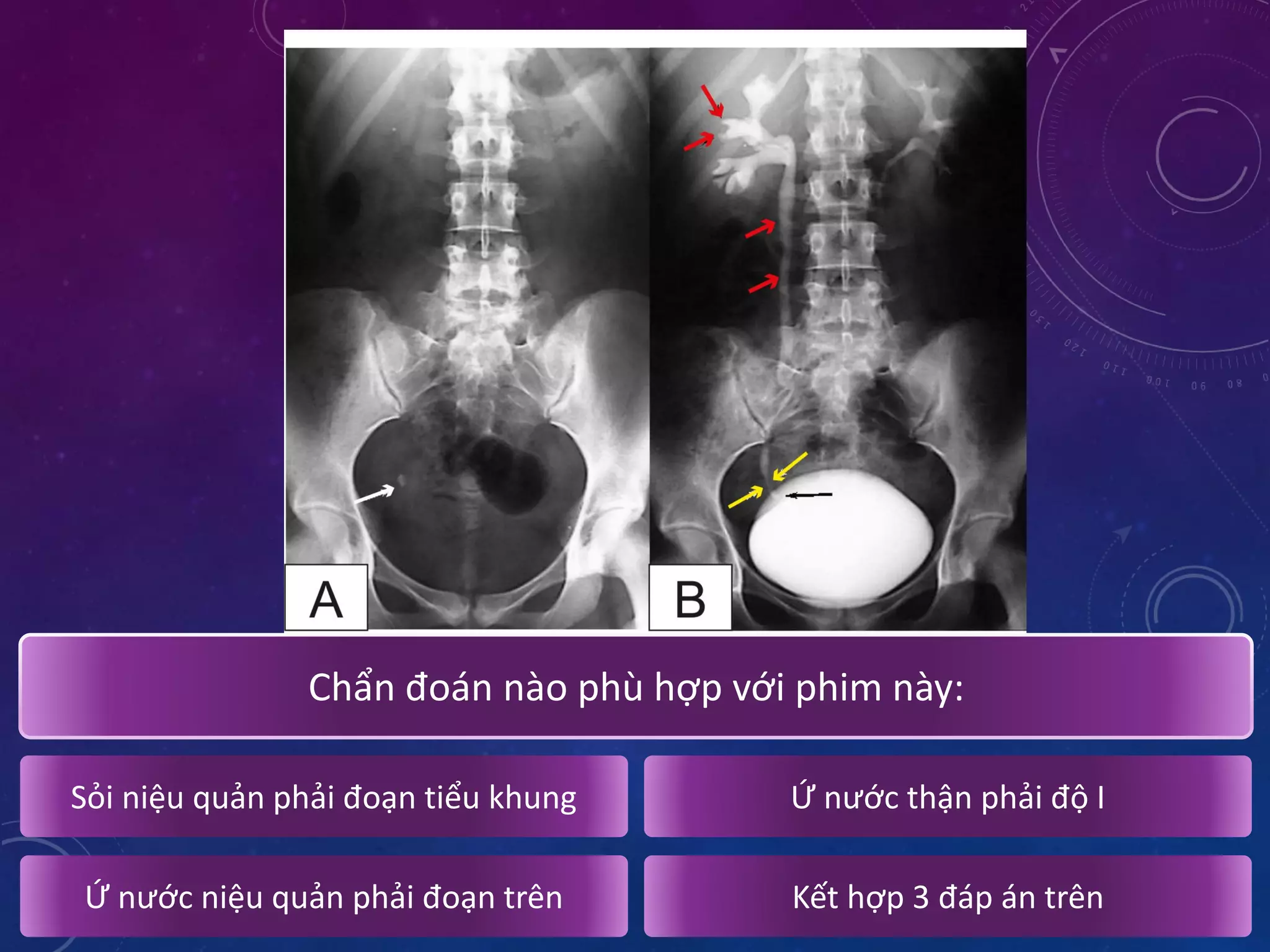 Thực hành Xquang hệ tiết niệu và cấp cứu bụng | PDF