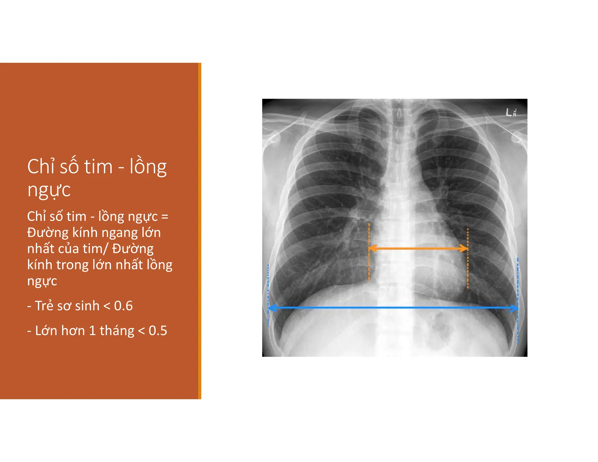 X quang trong benh ly tim mach, BS Ho Quoc Cuong (2018).pdf