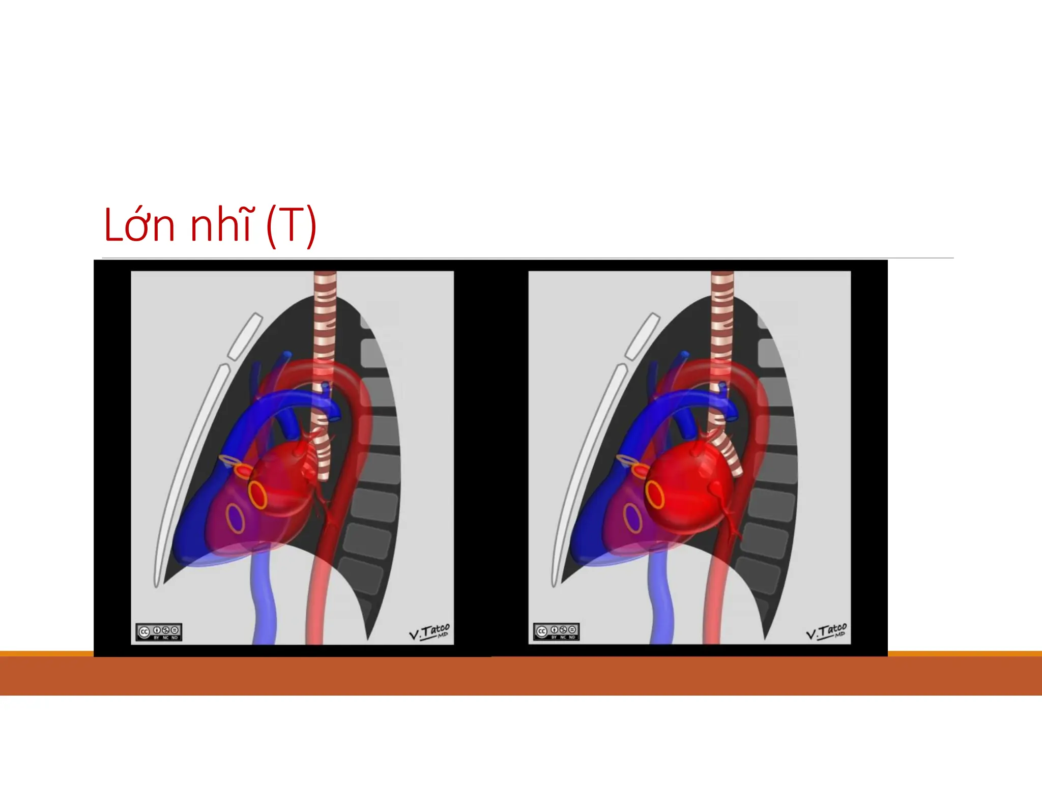 X quang trong benh ly tim mach, BS Ho Quoc Cuong (2018).pdf