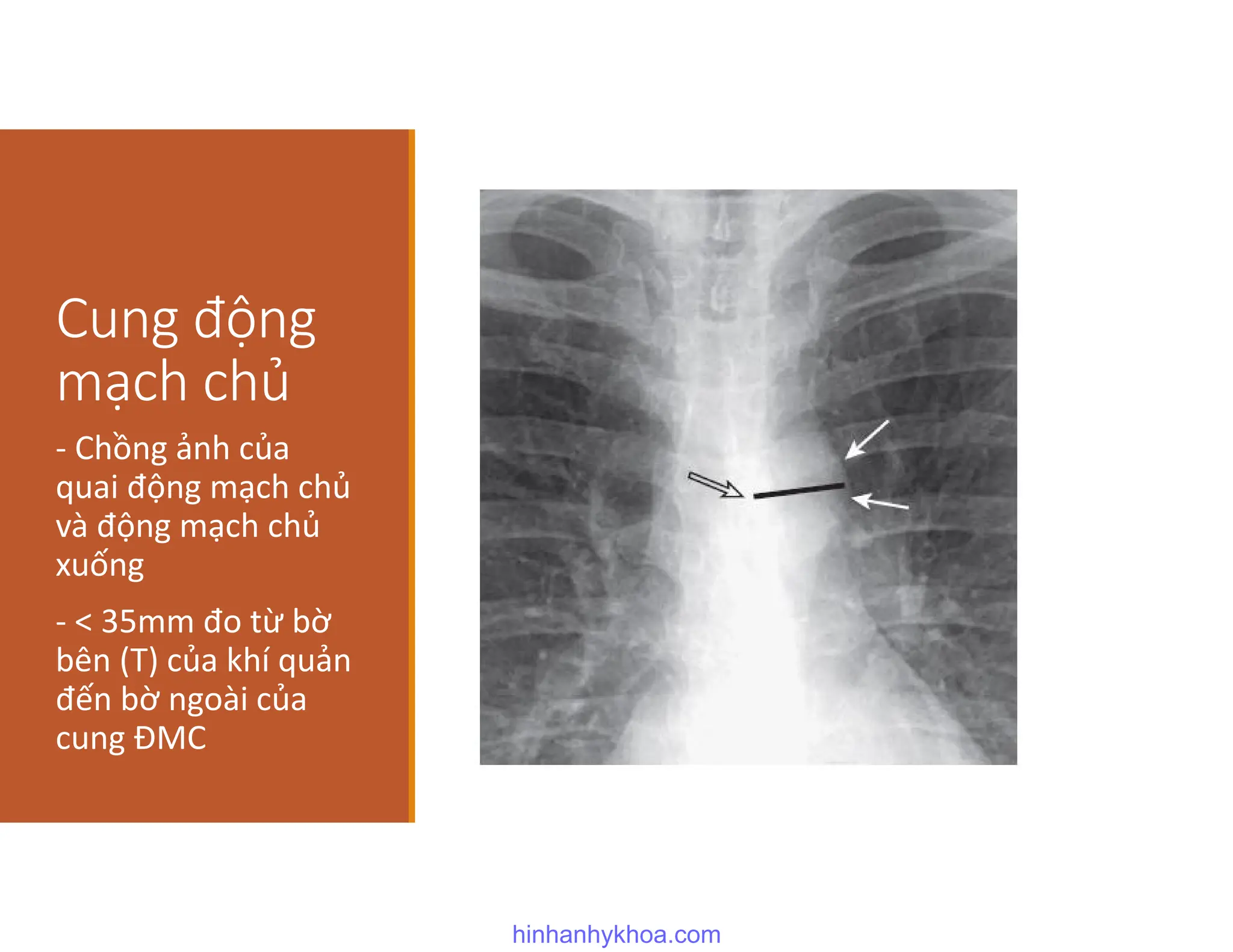 X quang trong benh ly tim mach, BS Ho Quoc Cuong (2018).pdf