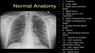Normal Chest X-Ray Labelled Anatomy PA View Part 1: CXR, 40% OFF