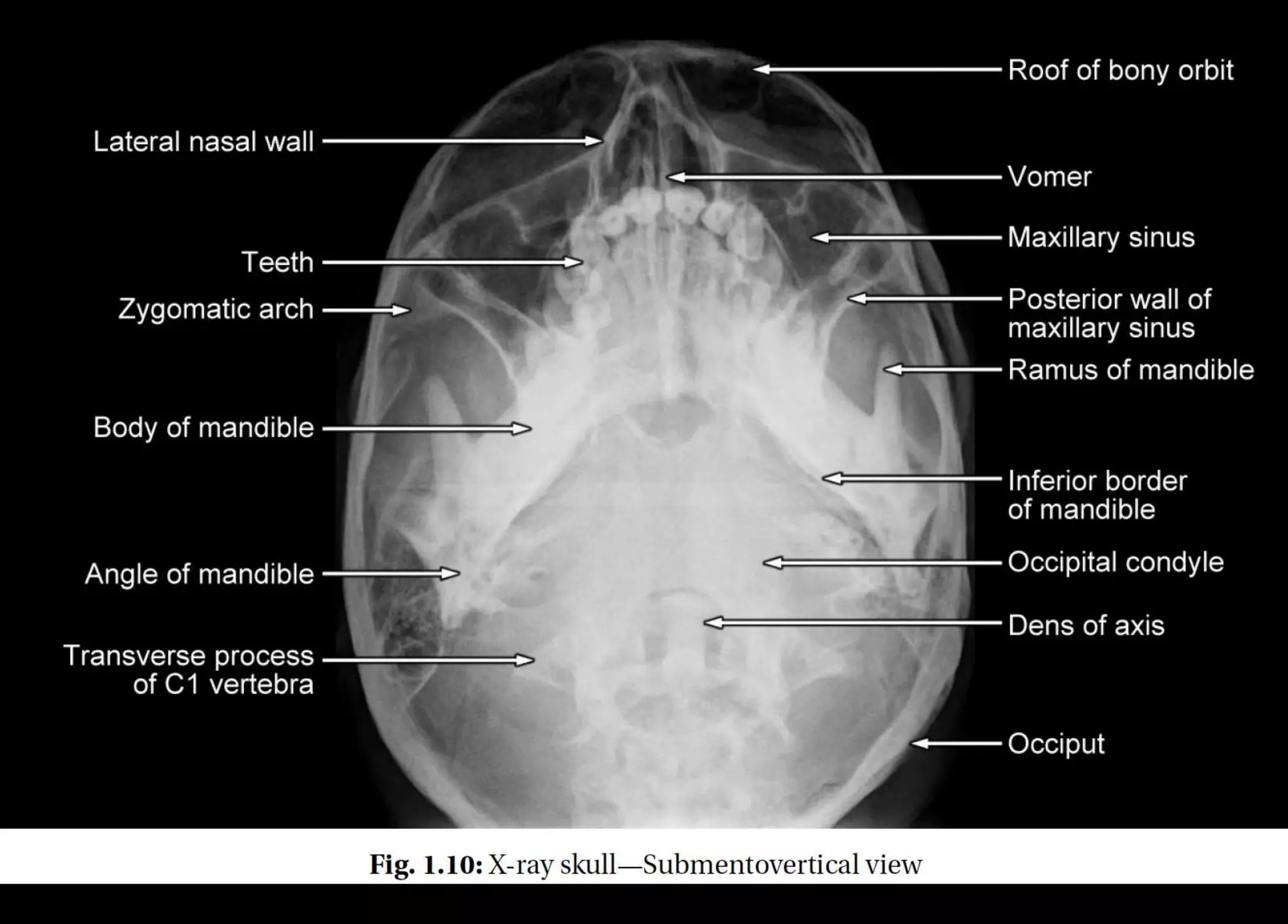 X rays in ENT | PPTX