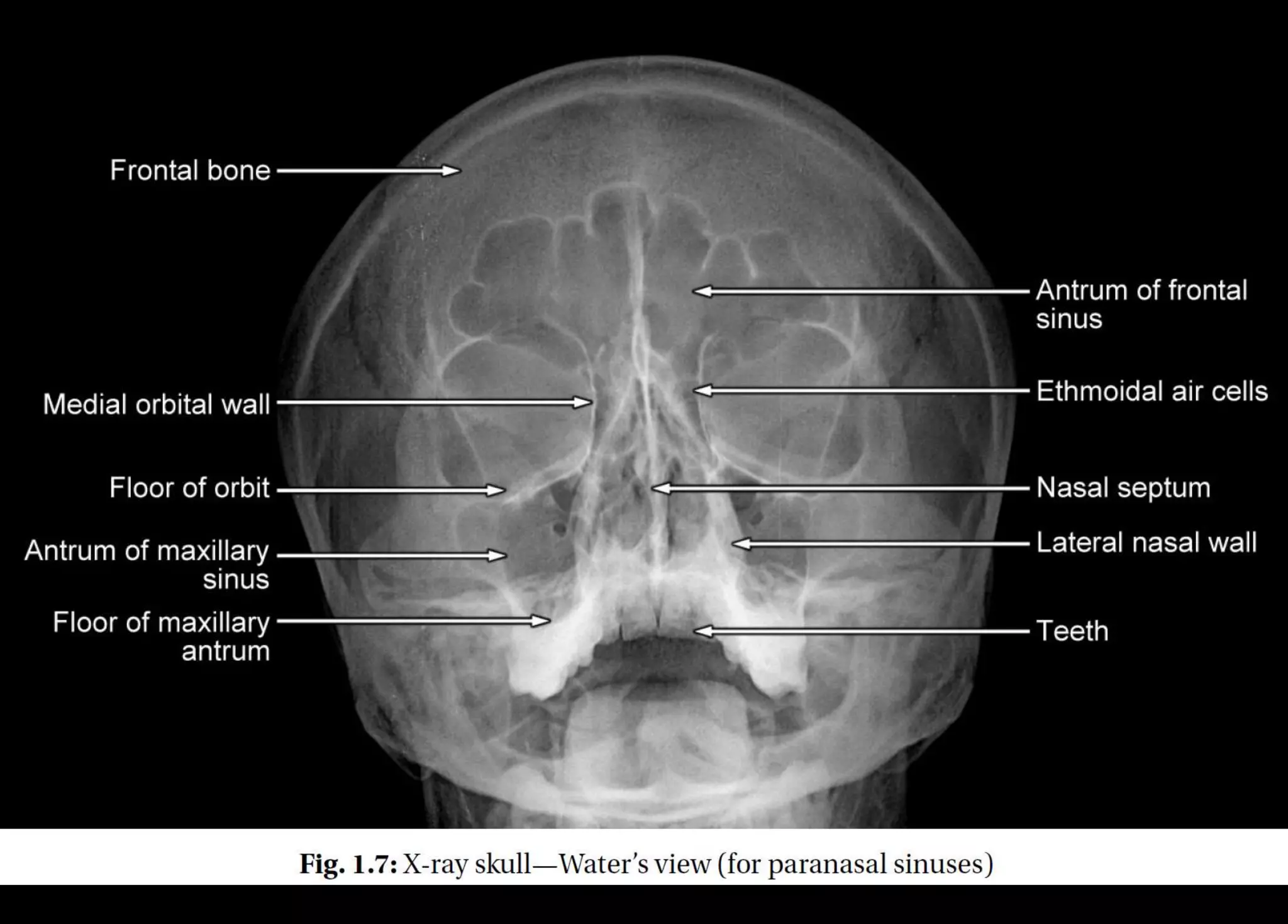 X rays in ENT | PPTX
