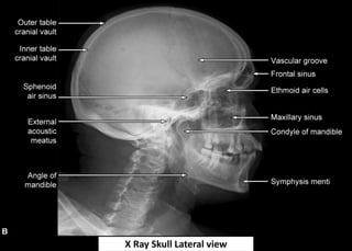Inferior Meatus Radiograph