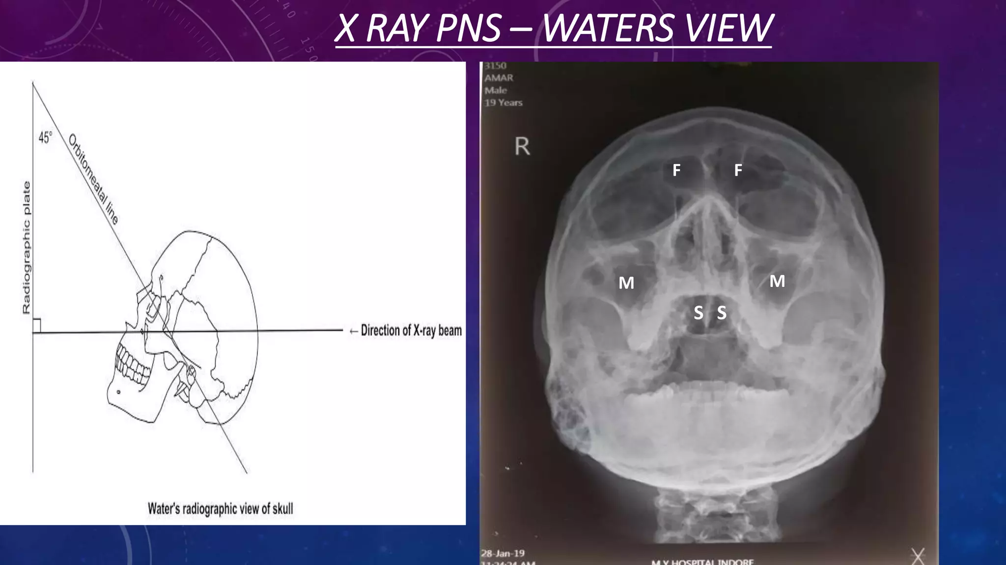 ENT radiology | PPTX