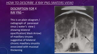 ENT radiology | PPTX