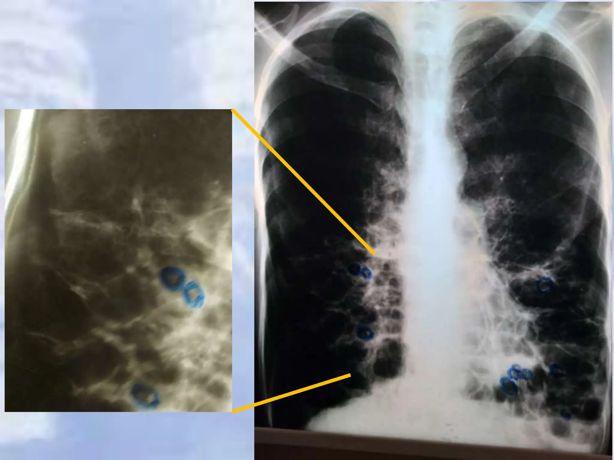 X ray basics of chest radiological findings.pdf