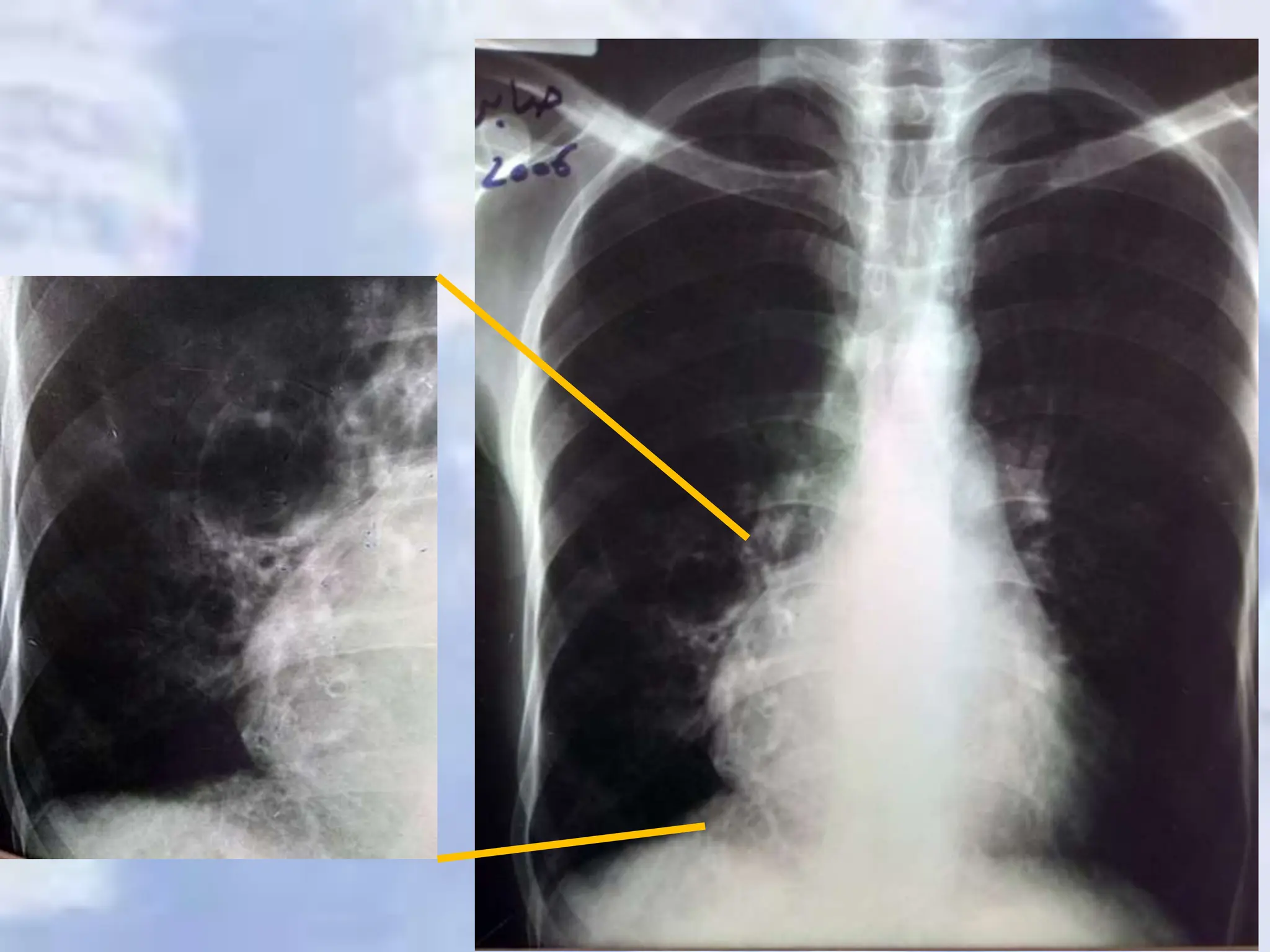 X ray basics of chest radiological findings.pdf