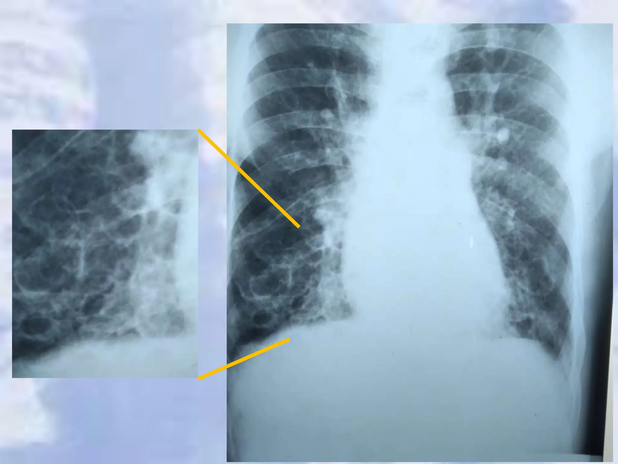 X ray basics of chest radiological findings.pdf