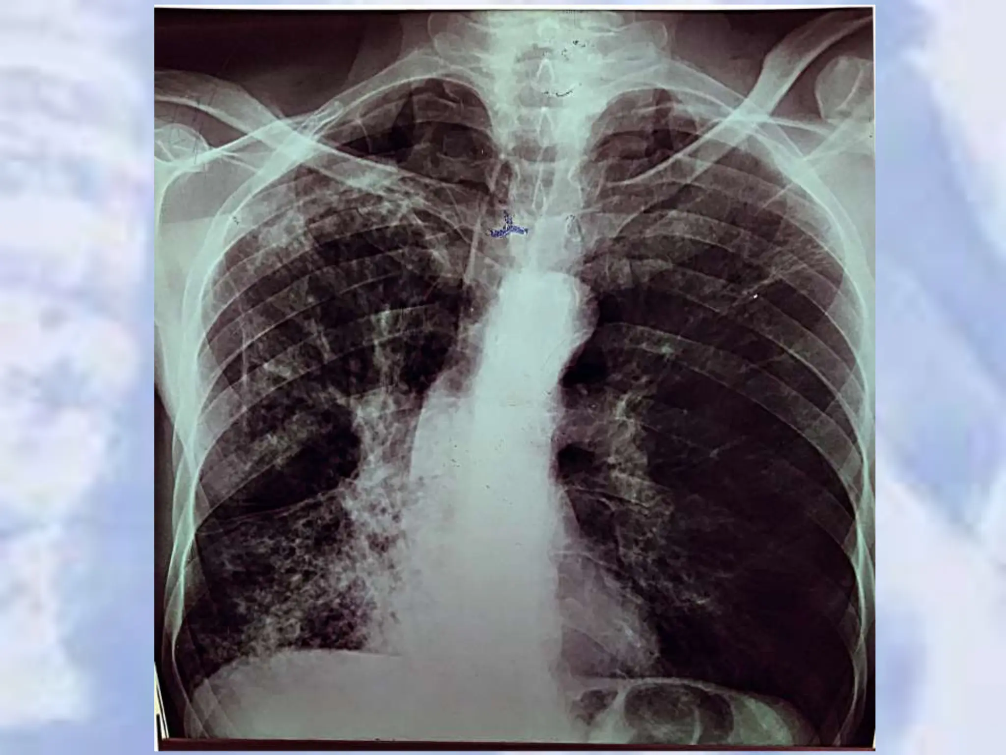 X ray basics of chest radiological findings.pdf