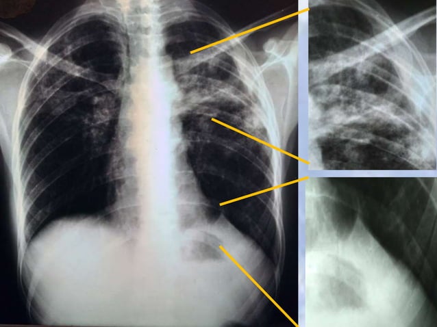 X ray basics of chest radiological findings.pdf