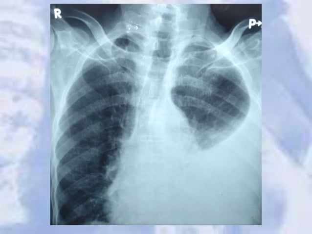 X ray basics of chest radiological findings.pdf