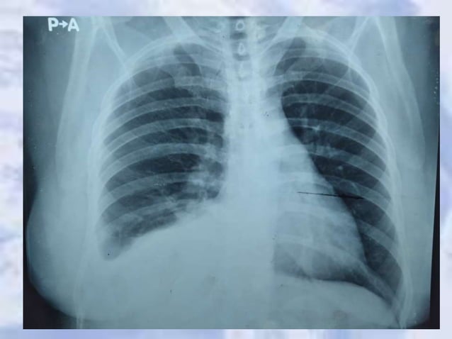 X ray basics of chest radiological findings.pdf