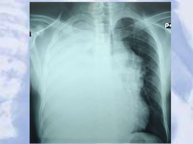 X ray basics of chest radiological findings.pdf