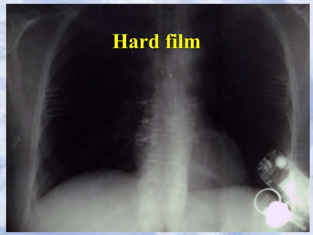 X ray basics of chest radiological findings.pdf