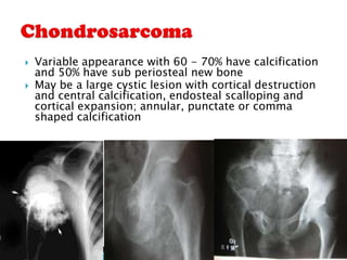 Xray bone tumor UG lecture | PPTX