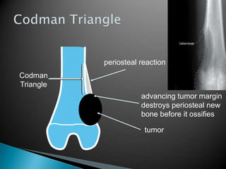 Osteosarcoma X Ray Codmans Triangle