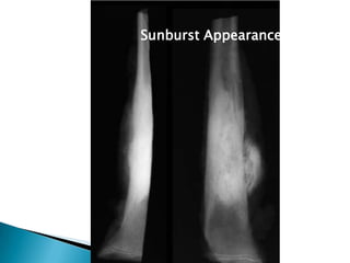 Osteosarcoma Sunray Appearance