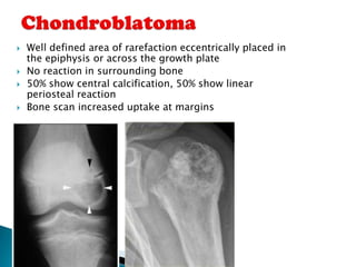 Chondroblastoma X Ray