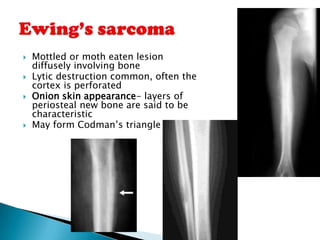 Ewing Sarcoma X Ray Onion Skin