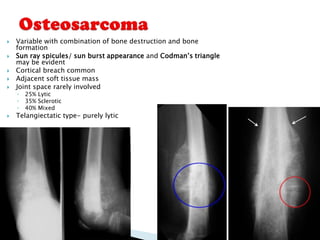 Osteosarcoma X Ray Codmans Triangle