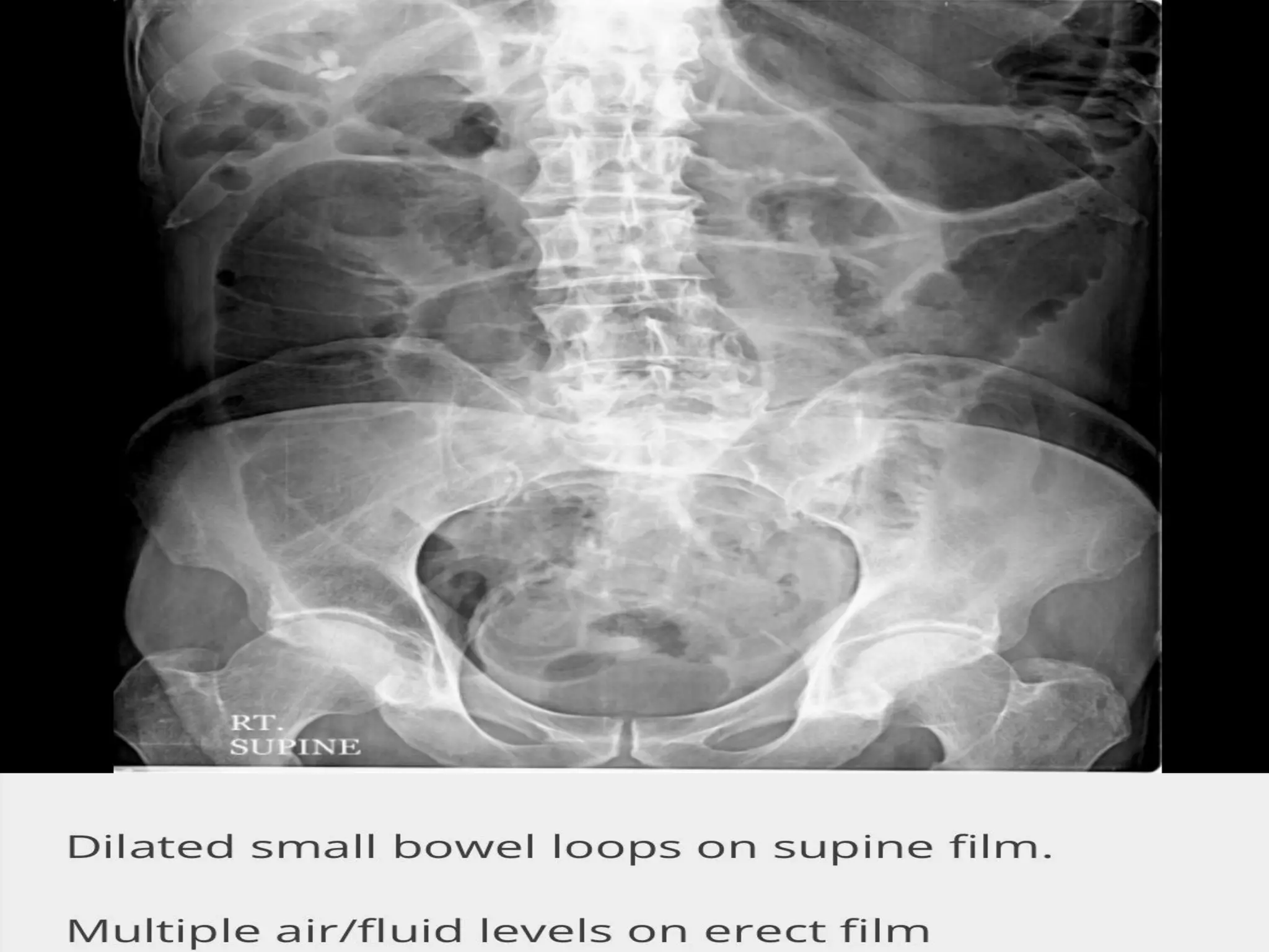Xray Abdomen and associated pathologies PPT.pptx