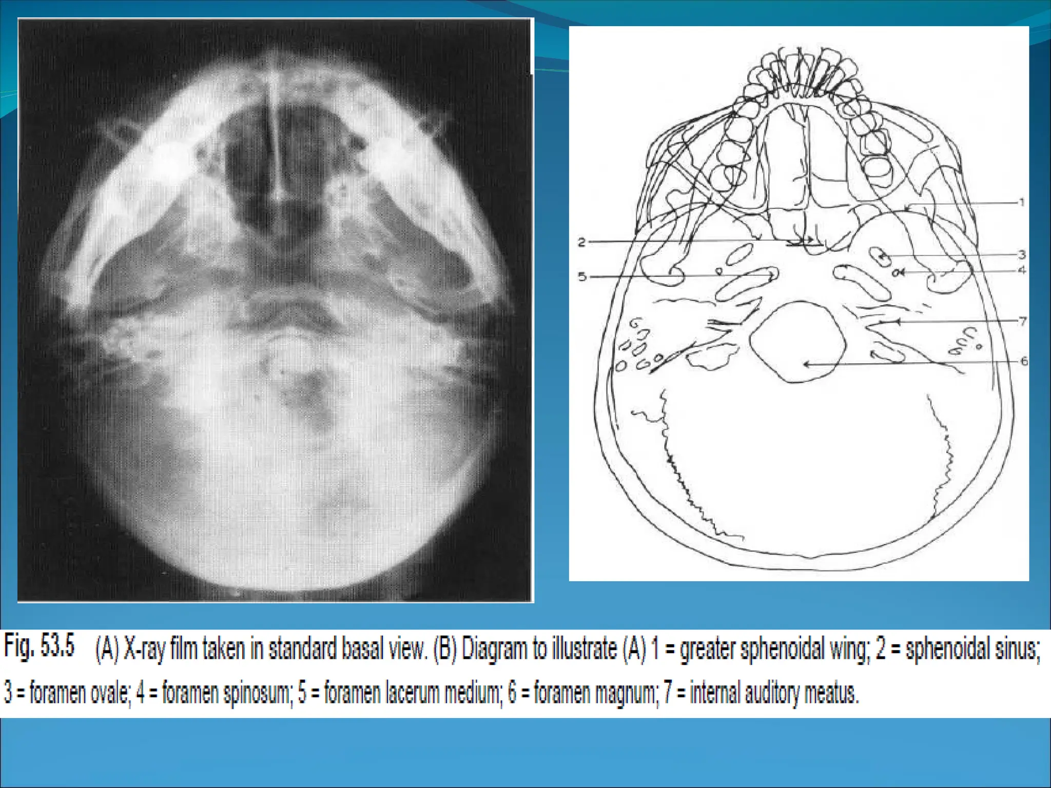 X RAY ANATOMY OF NORMAL SKULL.ppt heiejehehueh | PPT