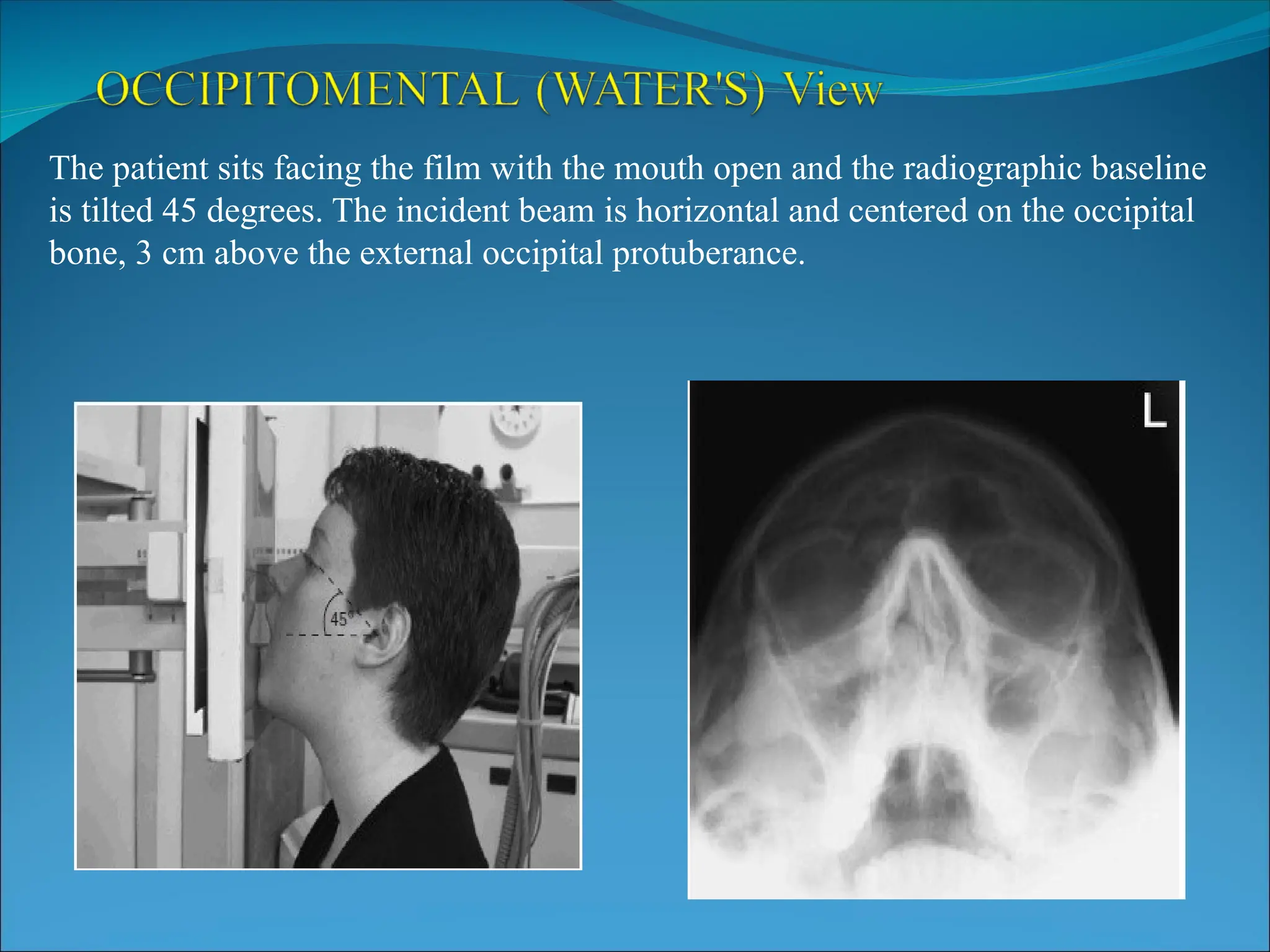 X RAY ANATOMY OF NORMAL SKULL.ppt heiejehehueh | PPT