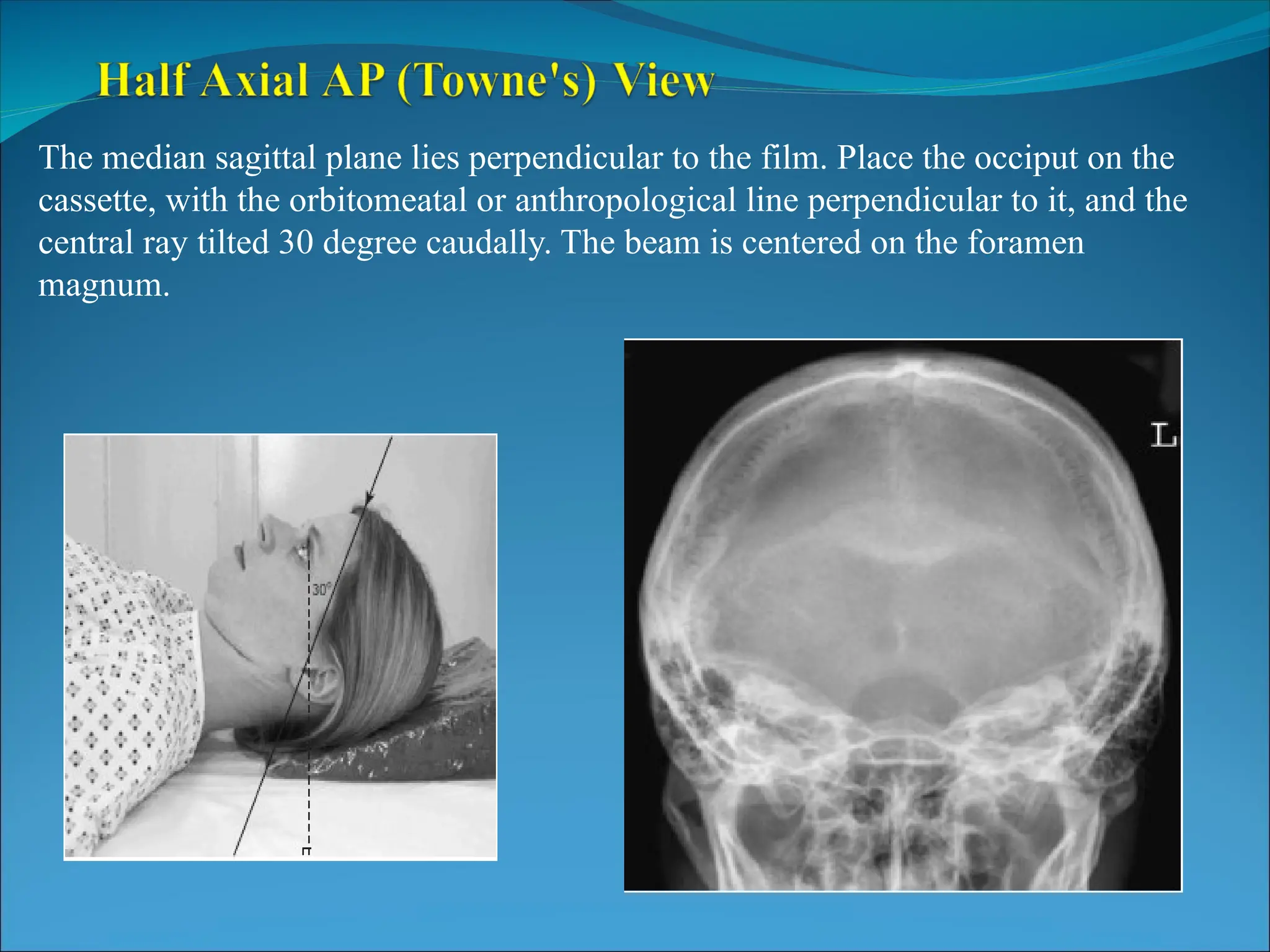 X RAY ANATOMY OF NORMAL SKULL.ppt heiejehehueh | PPT