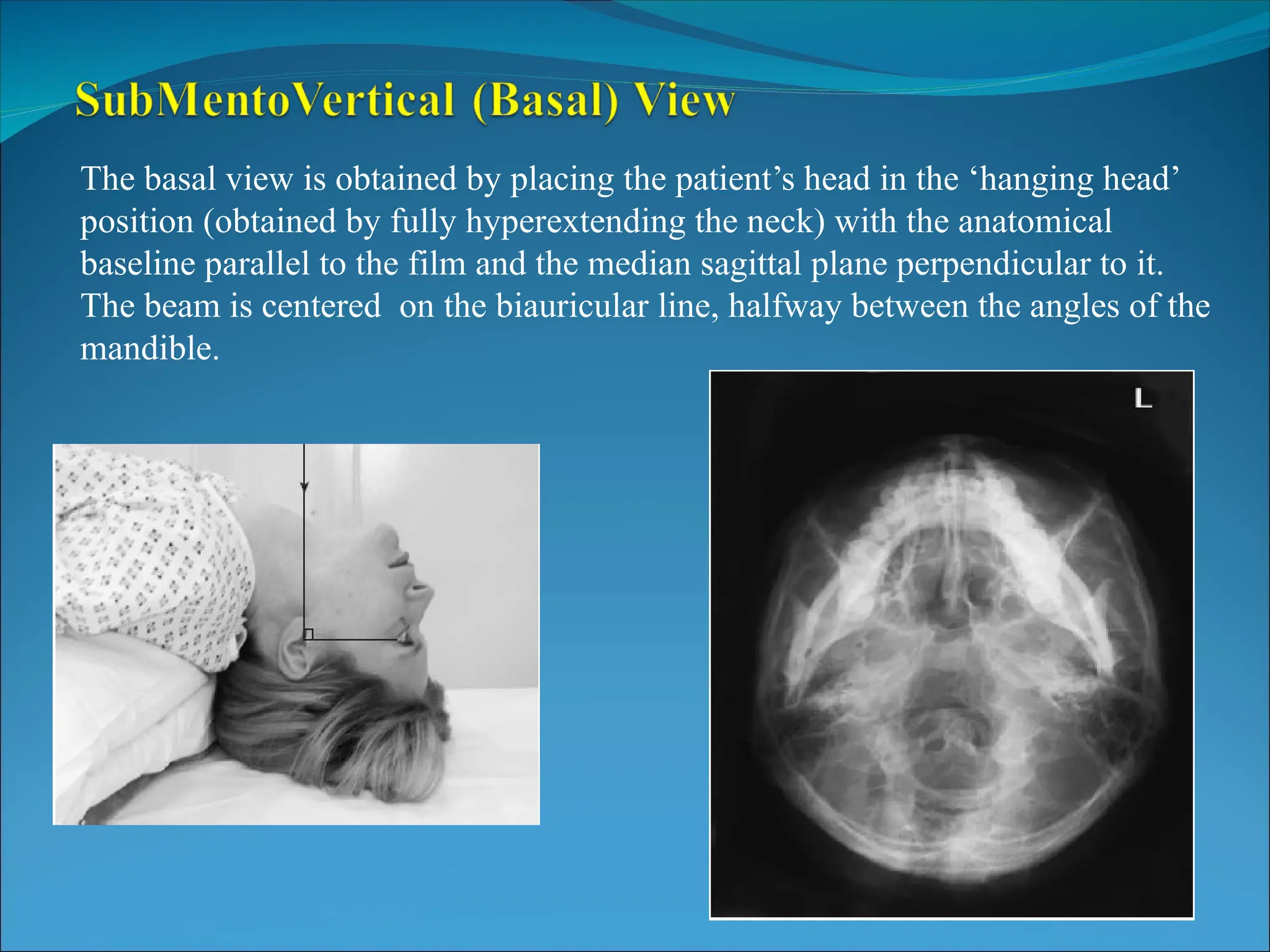 X RAY ANATOMY OF NORMAL SKULL.ppt heiejehehueh | PPT