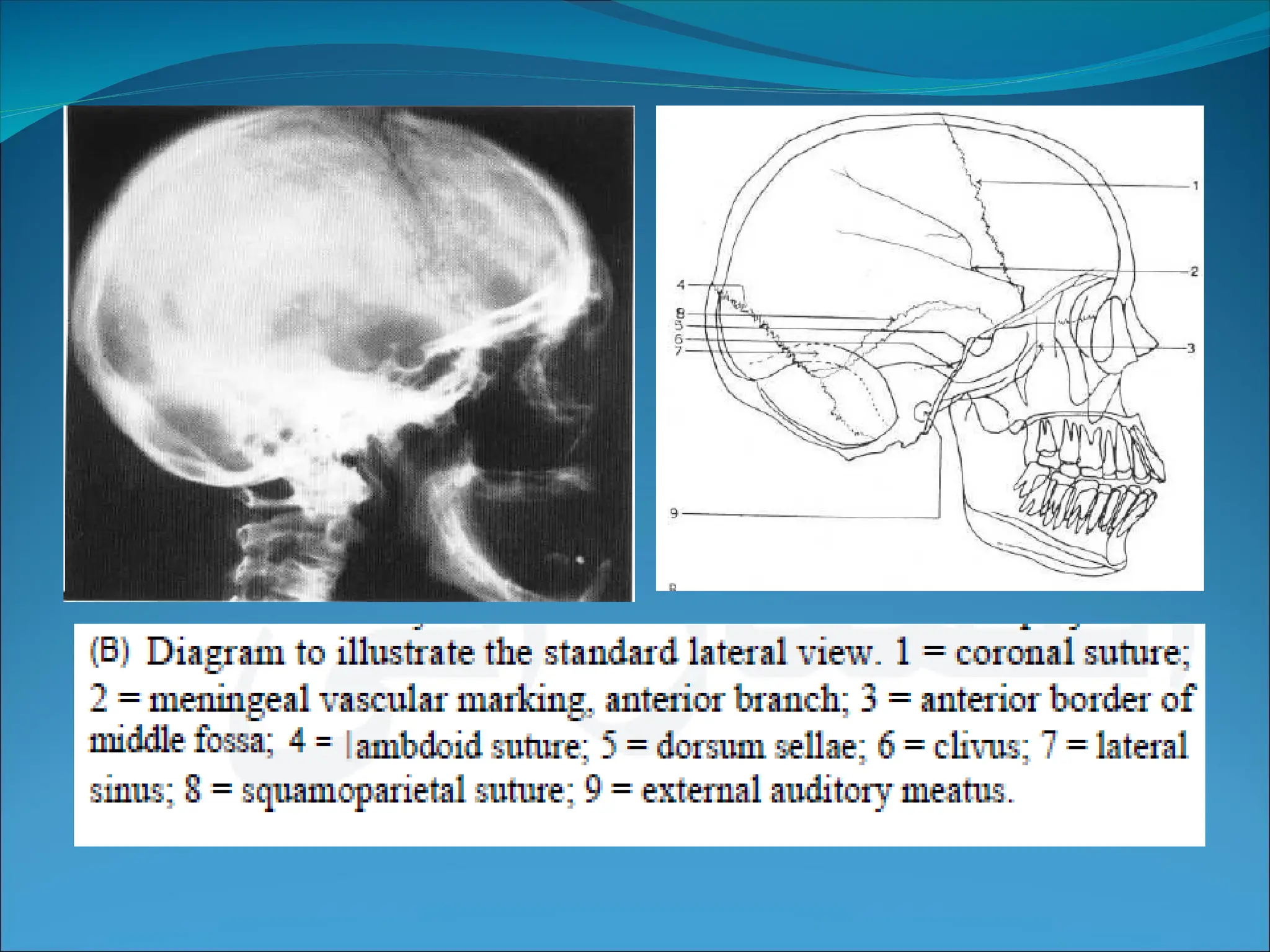 X RAY ANATOMY OF NORMAL SKULL.ppt heiejehehueh | PPT