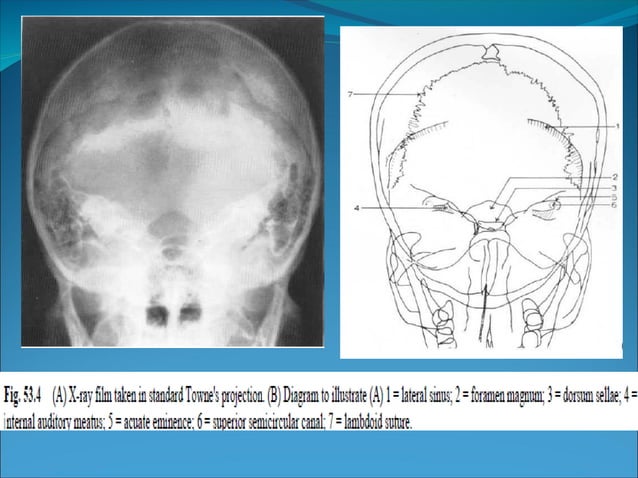 X RAY ANATOMY OF NORMAL SKULL.ppt heiejehehueh | PPT
