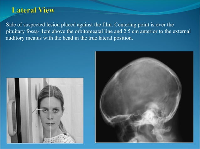 X RAY ANATOMY OF NORMAL SKULL.ppt heiejehehueh | PPT