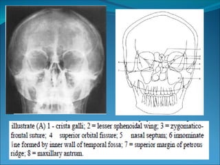 X RAY ANATOMY OF NORMAL SKULL.ppt heiejehehueh | PPT