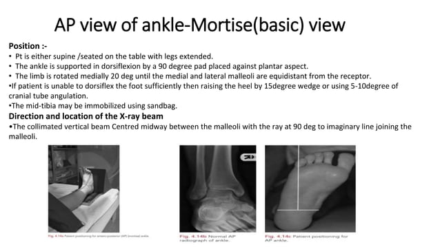 XRAY ANKLE POSITIONING.pptx | Death, Injury, or Military Conflict ...