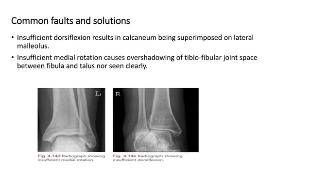 XRAY ANKLE POSITIONING.pptx | Death, Injury, or Military Conflict ...