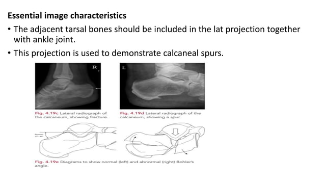 XRAY ANKLE POSITIONING.pptx | Death, Injury, or Military Conflict ...