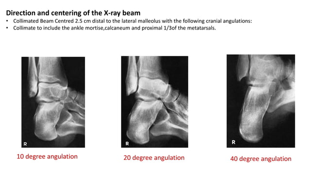 XRAY ANKLE POSITIONING.pptx | Death, Injury, or Military Conflict ...