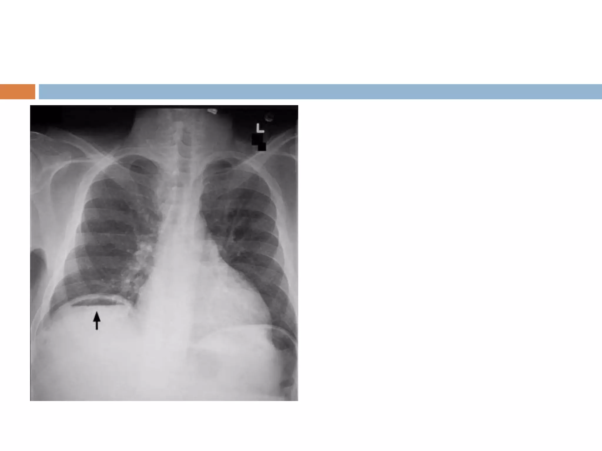 chest X ray basics and interpretation | PPTX | Lung and Respiratory ...