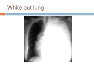 chest X ray basics and interpretation | PPT