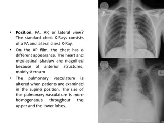 x ray chest.pptx