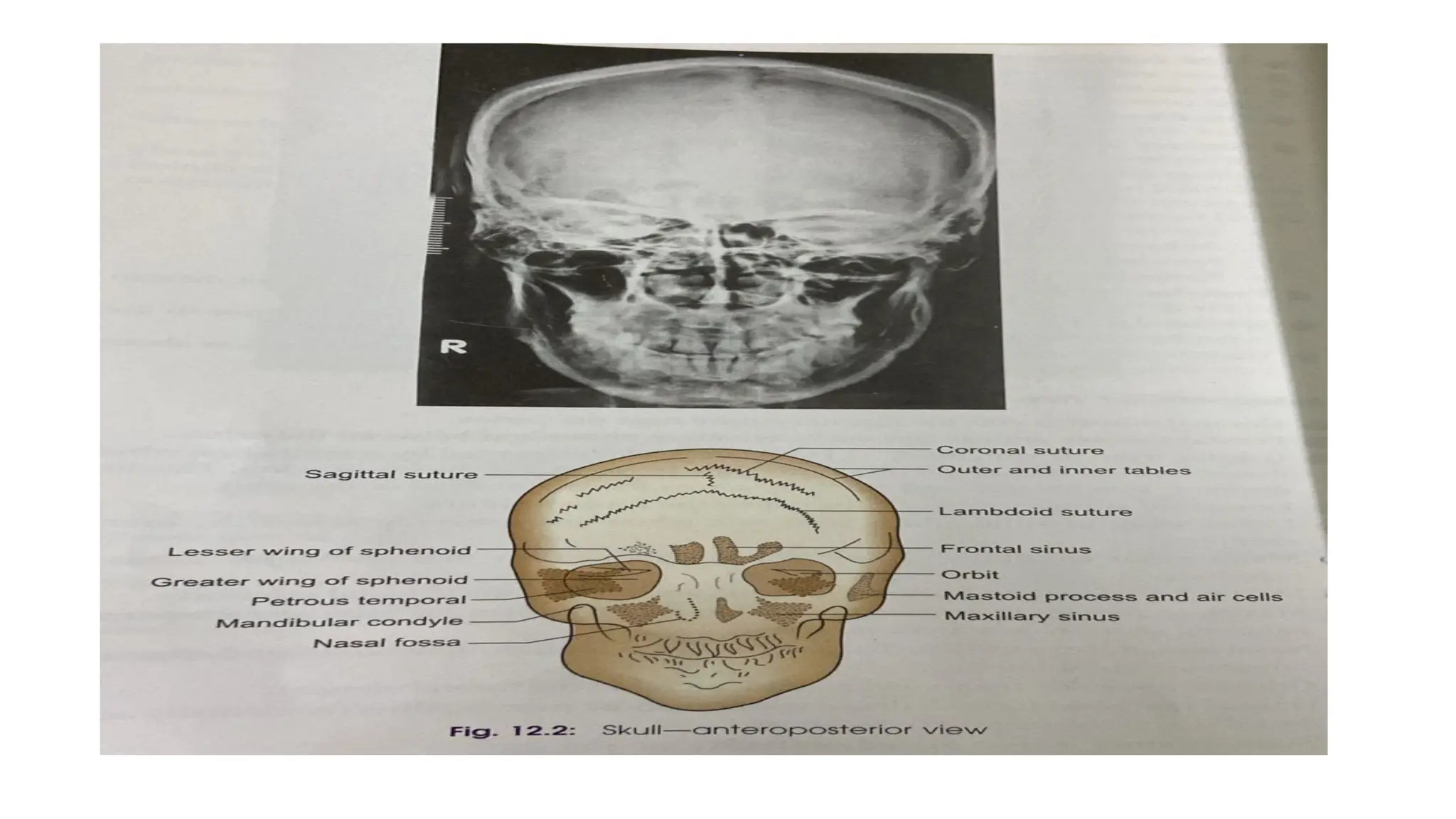 x ray cranium [Autosaved].pptx cranium xray | PPTX