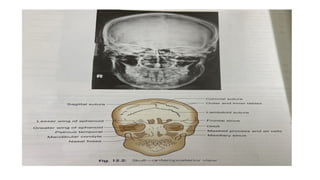 x ray cranium [Autosaved].pptx cranium xray | PPT